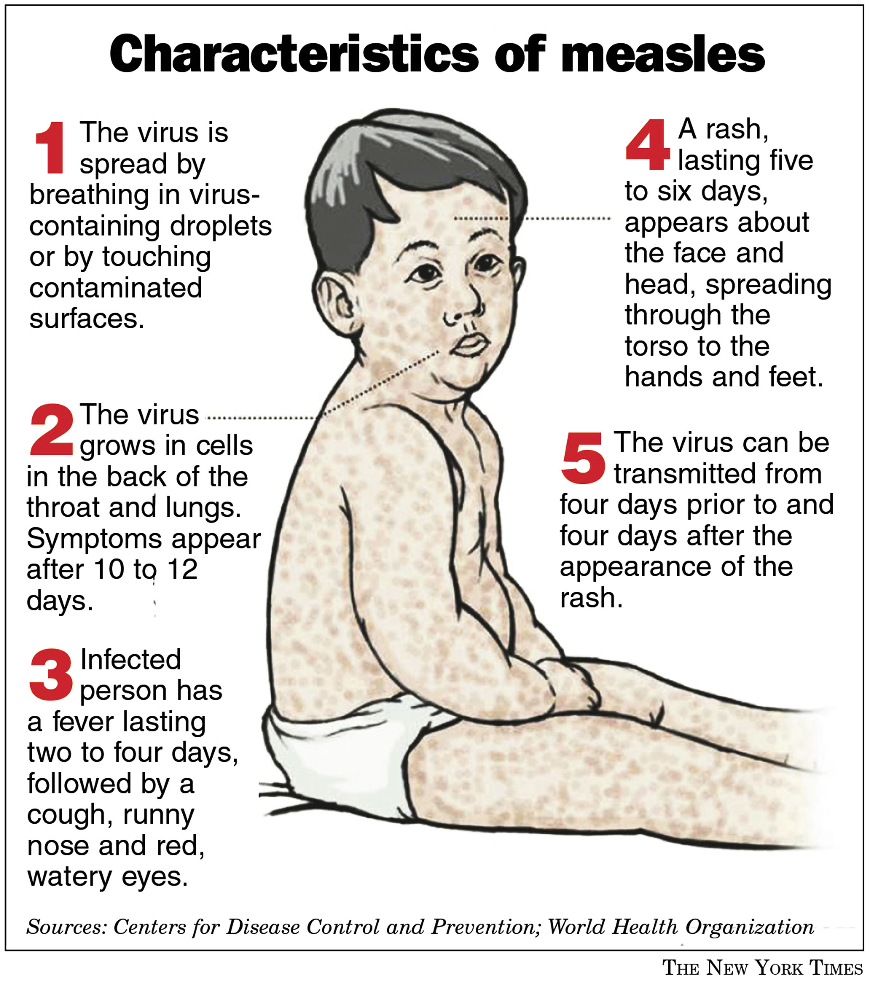 More measles cases feared on North Olympic Peninsula after unvaccinated ...